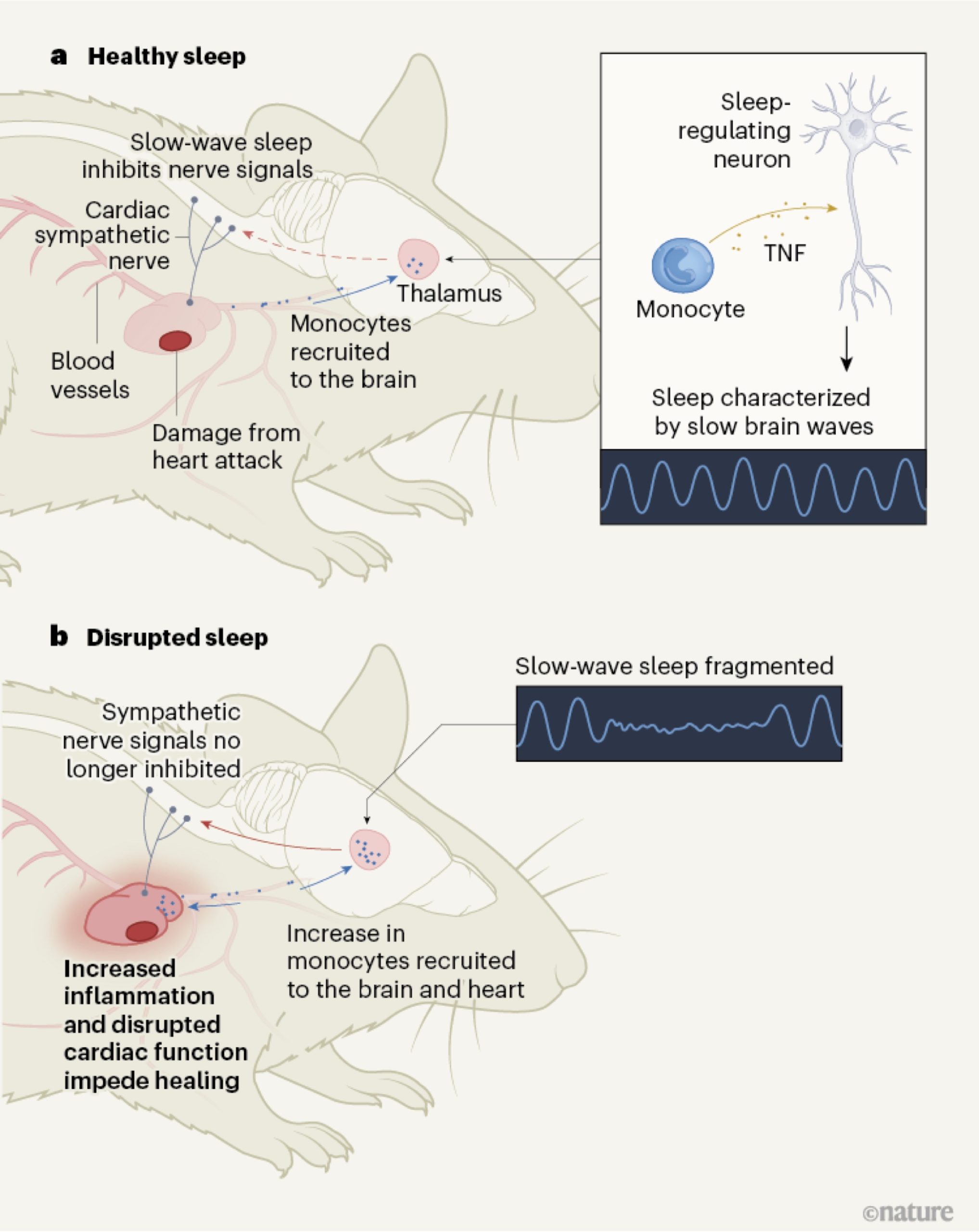 How sleep helps recovery after a heart attack | Prevention Observatory ...